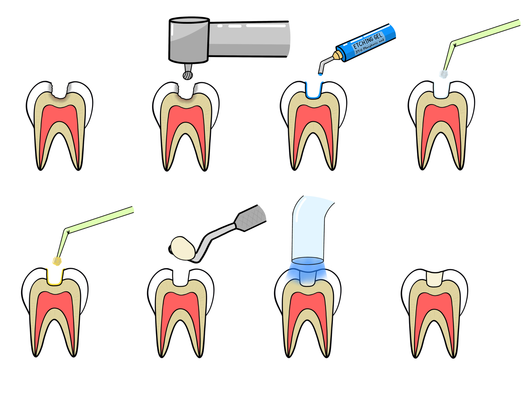 White Fillings - Earlsfield Dental Studios Dentist- Amalgam Replacement