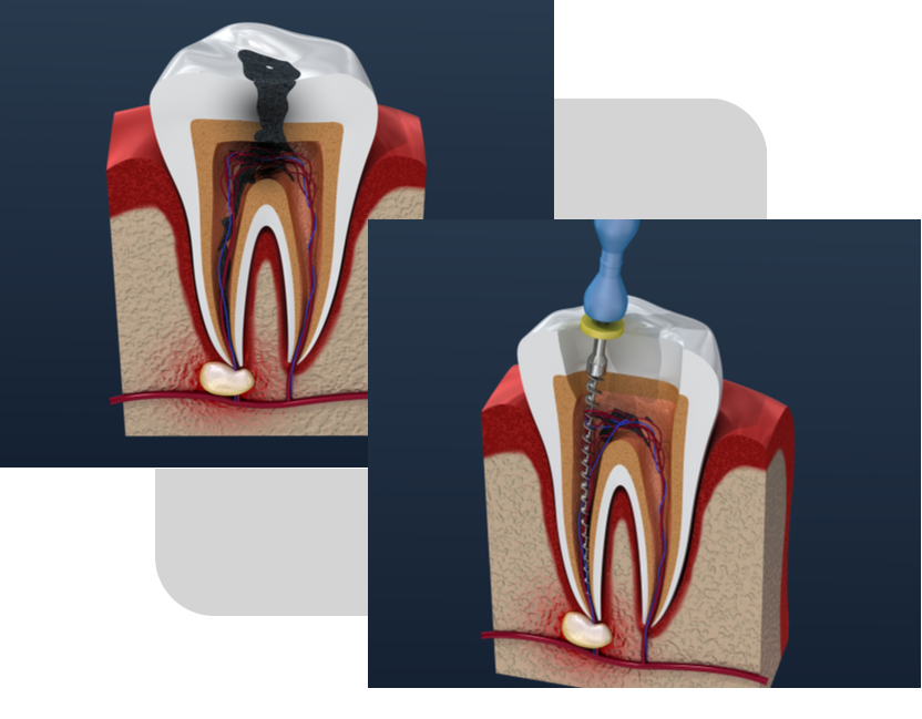 Root Canal Therapy - Earlsfield Dental Studios - Pain Relief